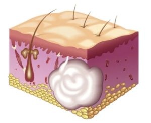Quiste Epidermoide | Innova Cirugía