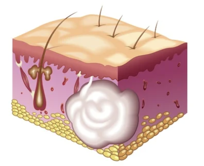 Quiste Epidermoide Innova Cirug a